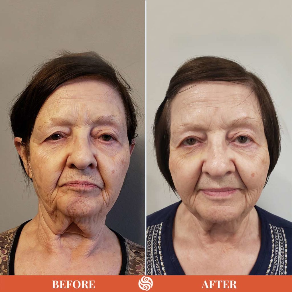 Tongue Placement - Block Therapy