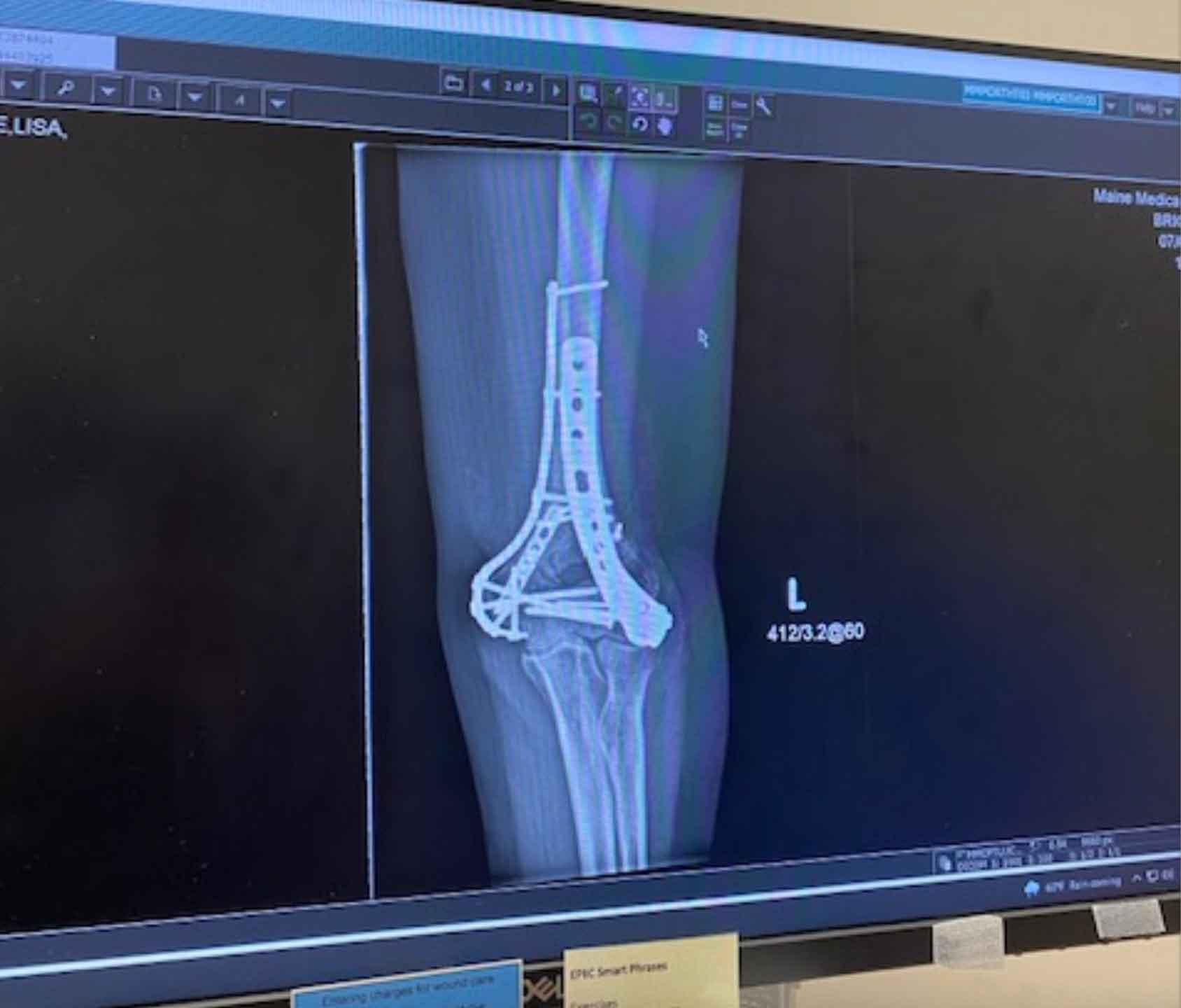 Miraculous Healing or Fascia Decompression? - Block Therapy